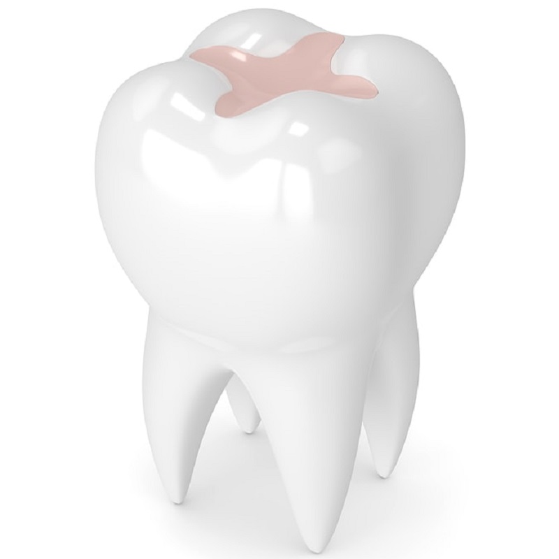 Sellado De Fosetas Y Fisuras - GNUX Dental